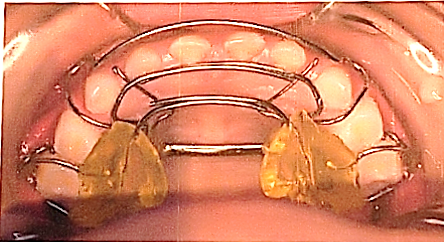 Biobloc治療導入セミナー(第3回目) – いいじま歯科クリニック採用サイト